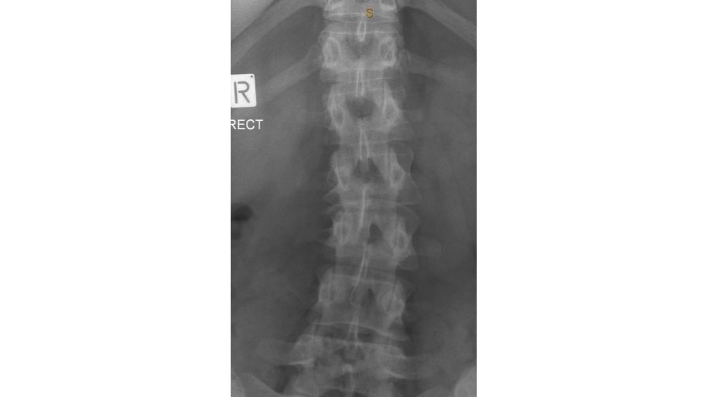 Lower Spinal Infusion Surgery