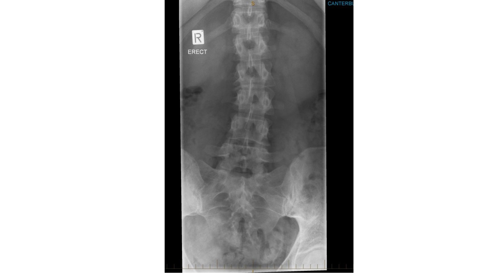 Lower Spinal Infusion Surgery