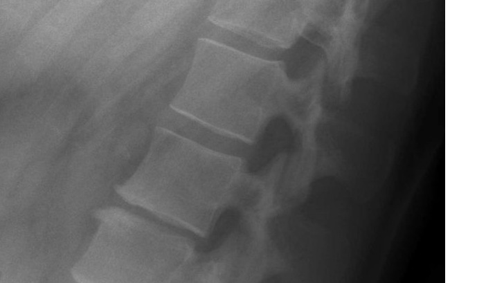 Lower Spinal Infusion Surgery