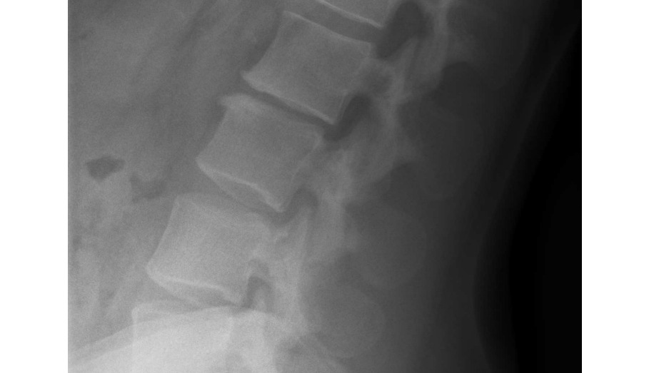 Lower Spinal Infusion Surgery